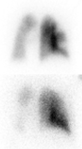 Diagnosis of Pulmonary Embolism | NucsRadiology.com